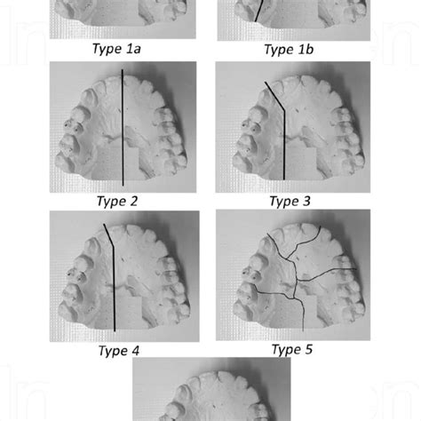 Pdf Maxillofacial Fractures From Diagnosis To Treatment