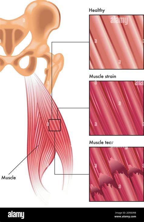 Medical Illustration Shows Healthy Muscle Fibers Compared To Muscle