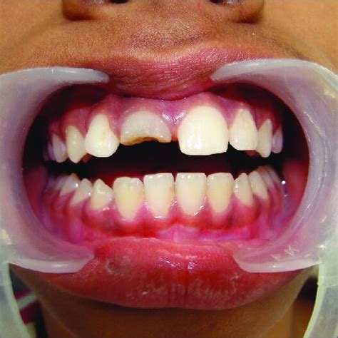 Ellis And Daveys Class Iv Fracture Of Maxillary Right Central Incisor Download Scientific Diagram