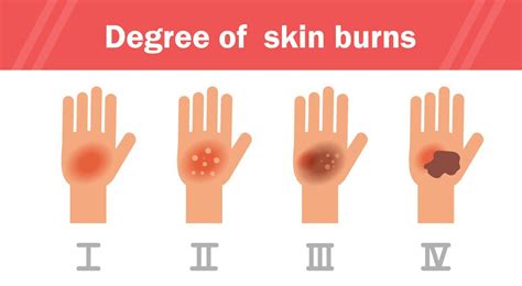 Minor Burn