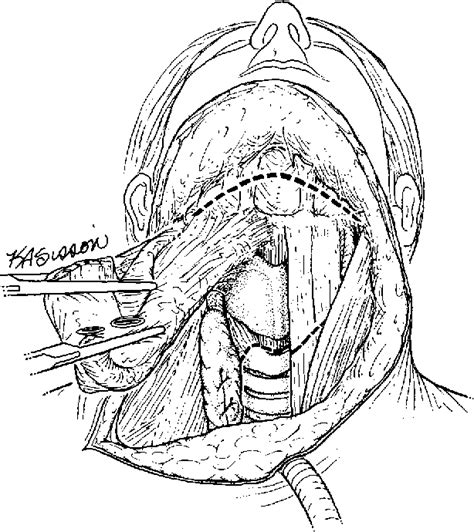 Figure 2 From Functional Restoration After Subtotal Glossectomy And