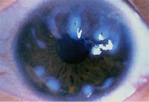 Salzmann Nodular Degeneration