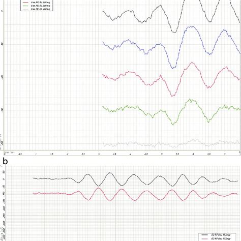 A C Examples Of Intracochlear ECoG Recordings For Tone Pips Or Click