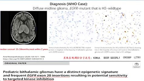 万锋教授：儿童高级别胶质瘤的诱导分化治疗探讨 脑医汇