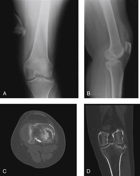 Open Reduction And Internal Fixation Of Tibial Plateau Fractures Musculoskeletal Key
