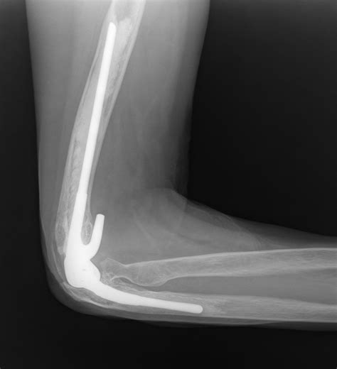 Rheumatoid Elbow The Clinical Advisor