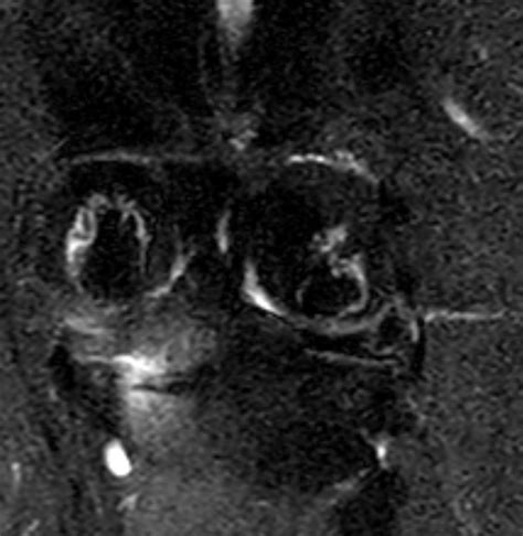 Bone Infarcts Knee Radiology Case