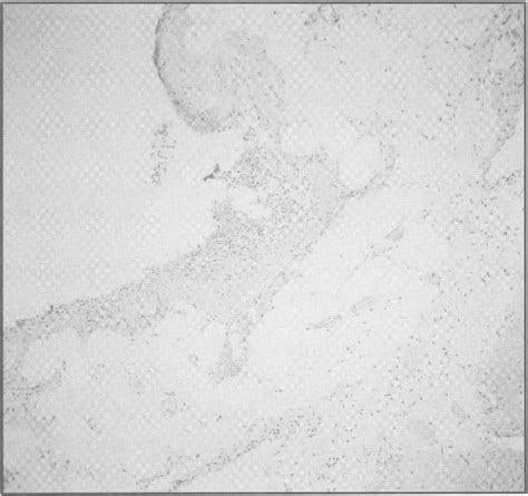 Figure 2 From Perforation Of The Sigmoid Colon Secondary To Localised Amyloidosis Semantic