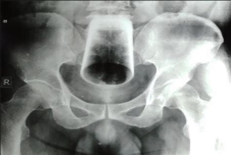 Man 47 Undergoes Surgery After Inserting Water Glass In His Rectum