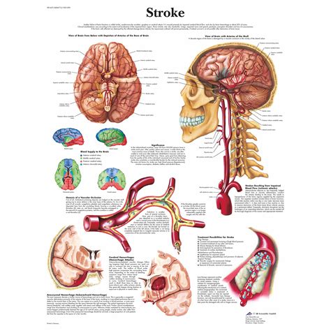 3b Scientific Stroke Chart