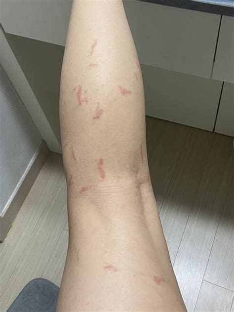 해파리 쏘여본사람 징그러움 주의 인스티즈 Instiz 익명잡담 카테고리