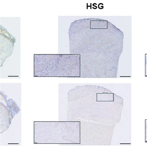 Immunohistochemical IHC Stains Of CD4 And CD8 On Tissue Biopsies From