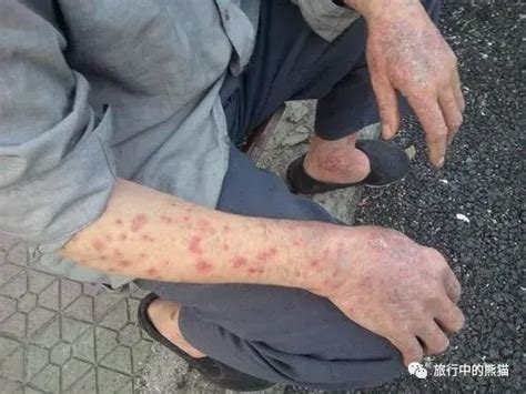 银屑病外用药推荐指南 知乎