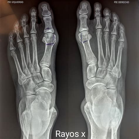 Cirugía De Hallux Valgus Juanetes Dr Jose Mario Dorantes Rodríguez