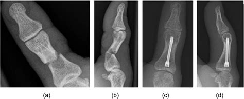 Figure 2 From Intramedullary Headless Screw Fixation For Fractures Of The Proximal And Middle
