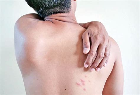 Heres How Shingles Chicken Pox Causing Virus Evades Immune System