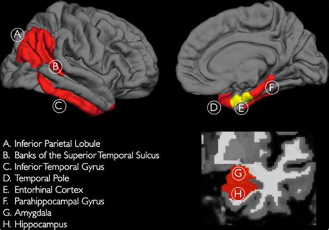 Three Dimensional Representations Of The Neuroanatomic Regions Examined