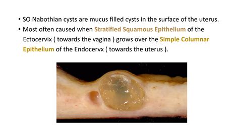 Benign Cervical Lesions Pptx