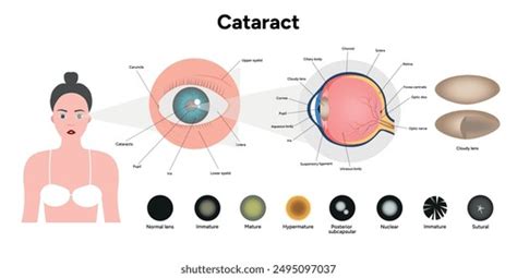 Cataracts Vision Disorder Eye Disease Diagram Stock Vector Royalty