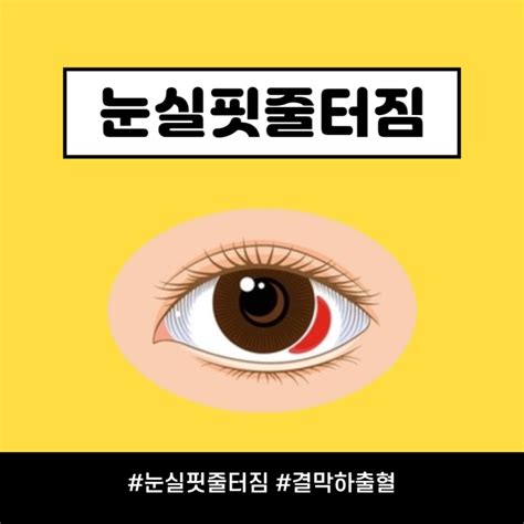 눈 실핏줄 터짐 결막하출혈 원인 치료 안약 충혈과 차이점 한번에 정리 네이버 블로그