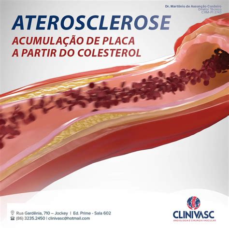 A Aterosclerose é O Acúmulo De Placas De Gordura Cálcio E Outras