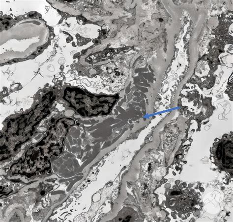 Subendothelial Crystals