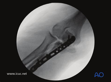 Open Reduction Internal Fixation For Anterior Transolecranon Fracture Dislocation