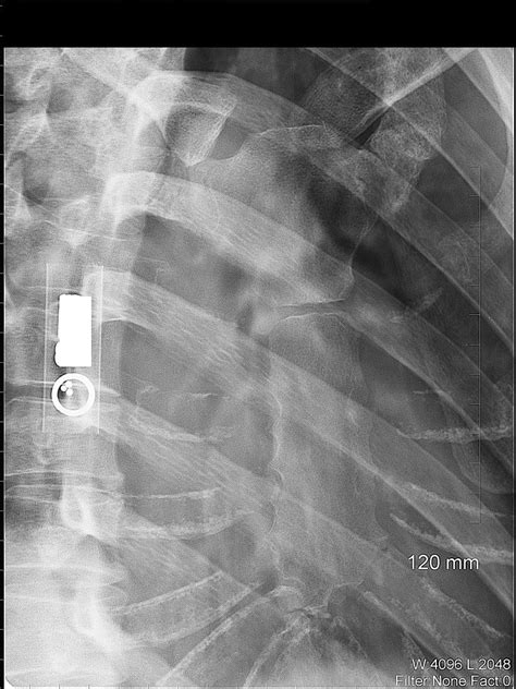 Sternum Normal Sternum With Pronounced Calcification Of Th… Flickr