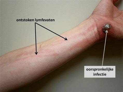 Lymfangitis Ontsteking Van Een Lymfevat Simptonl