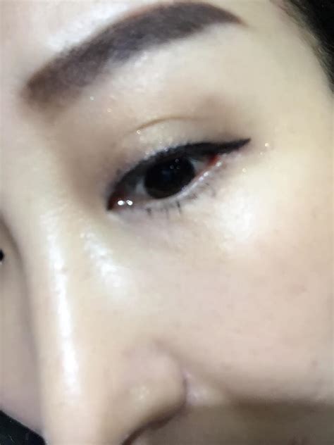 开眼角后遗症你们有吗？说说微整 知乎