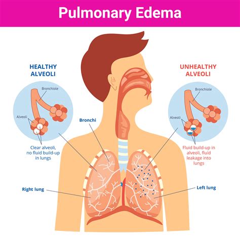 Pulmonary Edema Overview And Practice Questions 2023