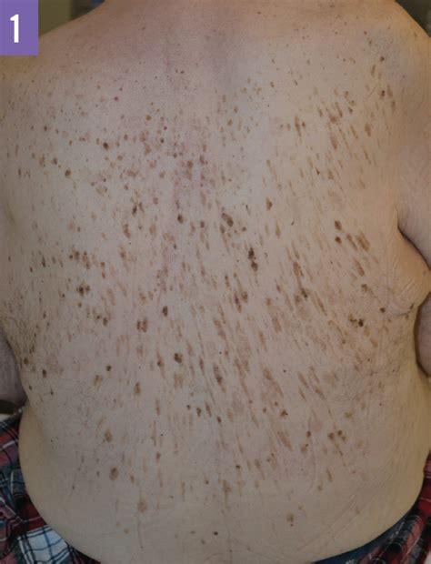 Sign Of Leser Trelat Clinical Presentation Aamgv