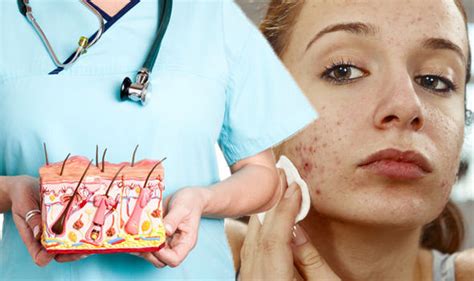 Acne Treatment Seven Ways To Ease Symptoms Of Skin Condition Acne In