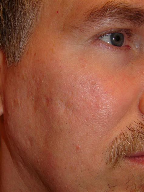 Bbl Laser Orange County Bbl Laser Treatment Mission Viejo Ca