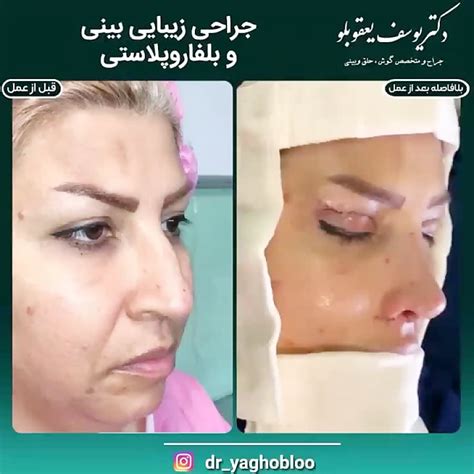 نمونه کار جراحی بینی دکتر یعقوبلو
