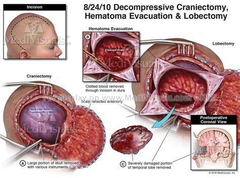 Decompressive Craniectomy Hematoma Evacuation And Lobectomy