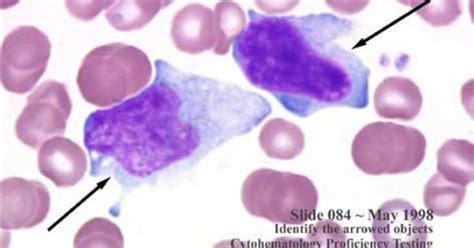 Reactive Lymphocytes Vs Atypical Lymphocytes
