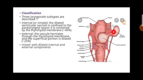 Laryngocele