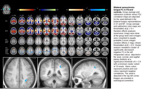 Regional Not Global Functional Connectivity Contributes To Isolated