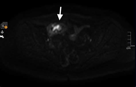 Infected Omental Infarction A Rare Complication Eurorad
