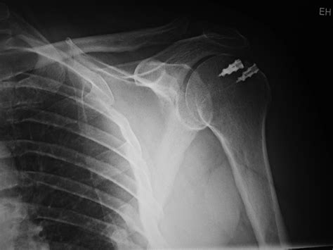 Rotator Cuff Tear Anchors