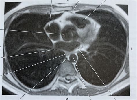 Axial T1 R Ventricle Diagram Quizlet