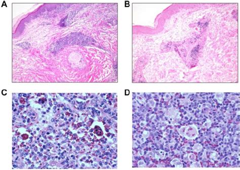 Ebv Disease Involving Skin Lymph Nodes And Spleen Skin From Patient