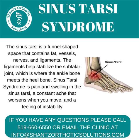 Shantz 🦶 Understanding Sinus Tarsi Syndrome 🦶 Sinus Tarsi Syndrome