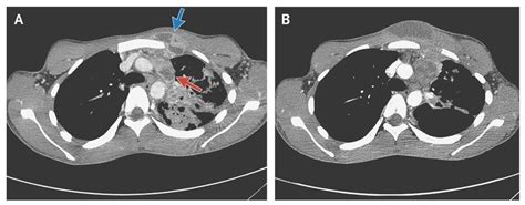 Tuberculous Abscess Manual Of Medicine