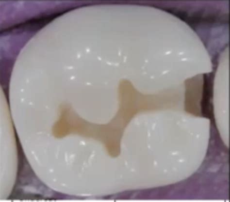 Week 5 Tooth Prep Review And Bases And Liners Flashcards Quizlet