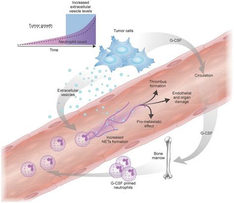 Tumor Progression Schematic Representation Of Tumor Development With