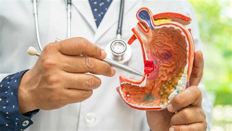 Duodenal Ulcer Symptoms