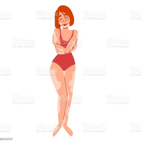 Vitiligo를 가진 유럽의 날씬한 여자 소녀는 자신을 안아줍니다 신체 양성 자기 수용의 개념 피부 질환 Vitiligo