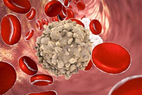 Silvio Berlusconi Soffre Di Leucemia Mielomonocitica Cronica MedicinaLive